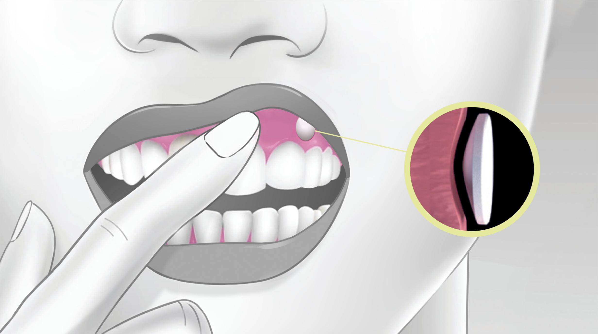 Traitement des boutons de fièvre | Virpax